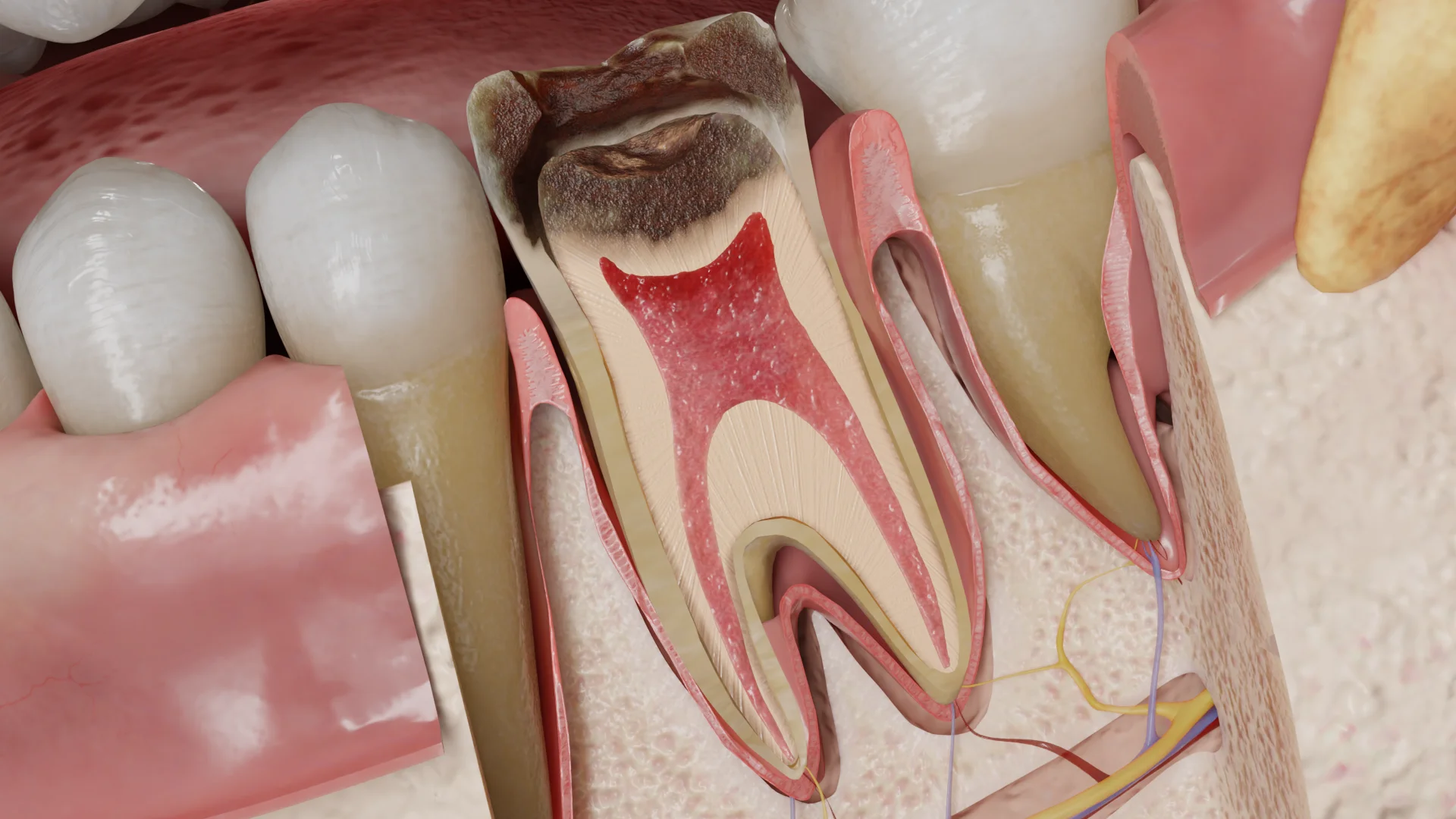 Pulpitis reversible: Etiología, diagnóstico, síntomas, tratamiento